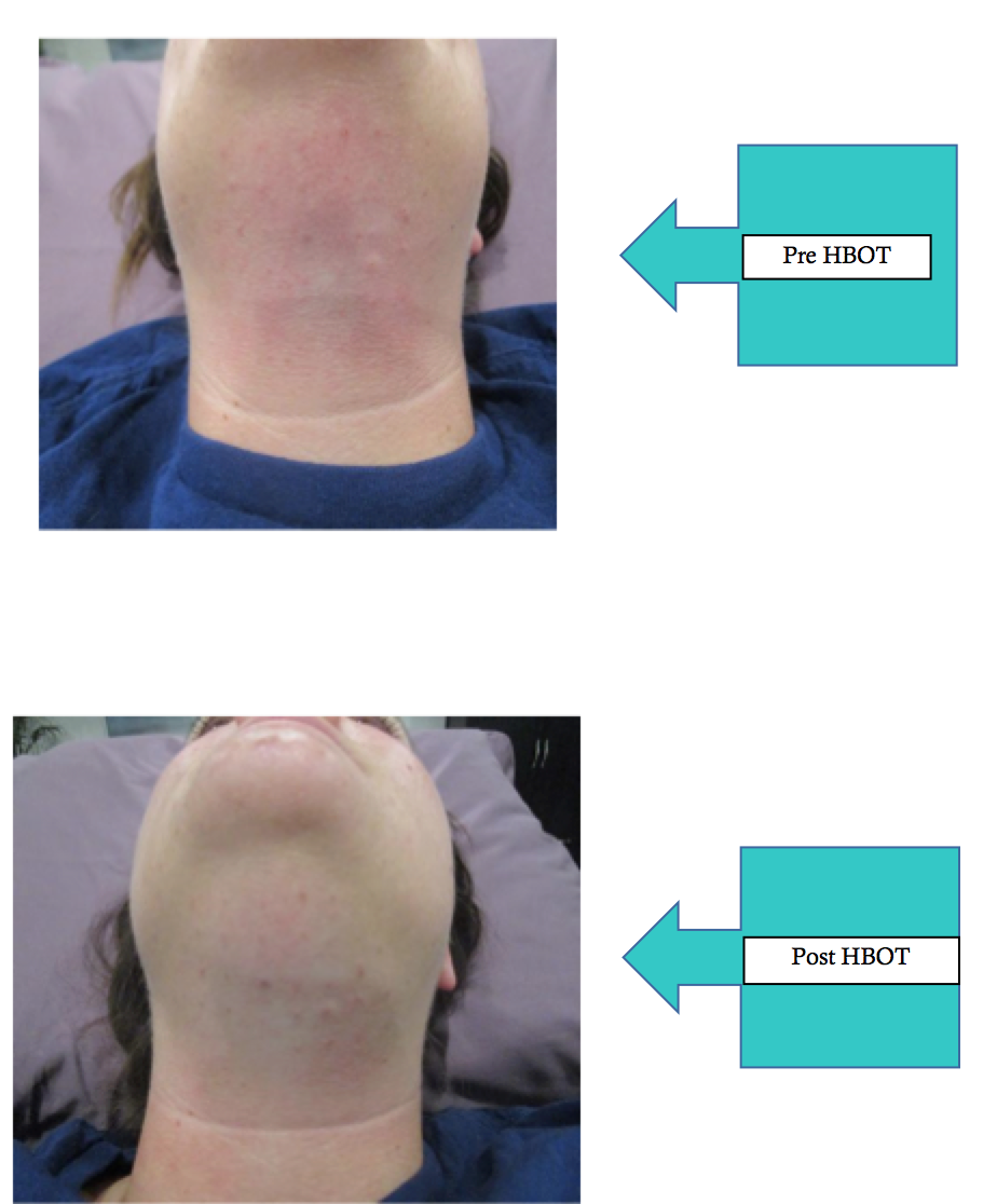 Kybella Treatment Orlando‎ | Hyperbaric Healing Treatment Center