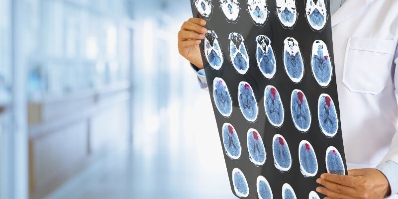 Thrombotic vs embolic stroke: Understand the differences | Hyperbaric ...